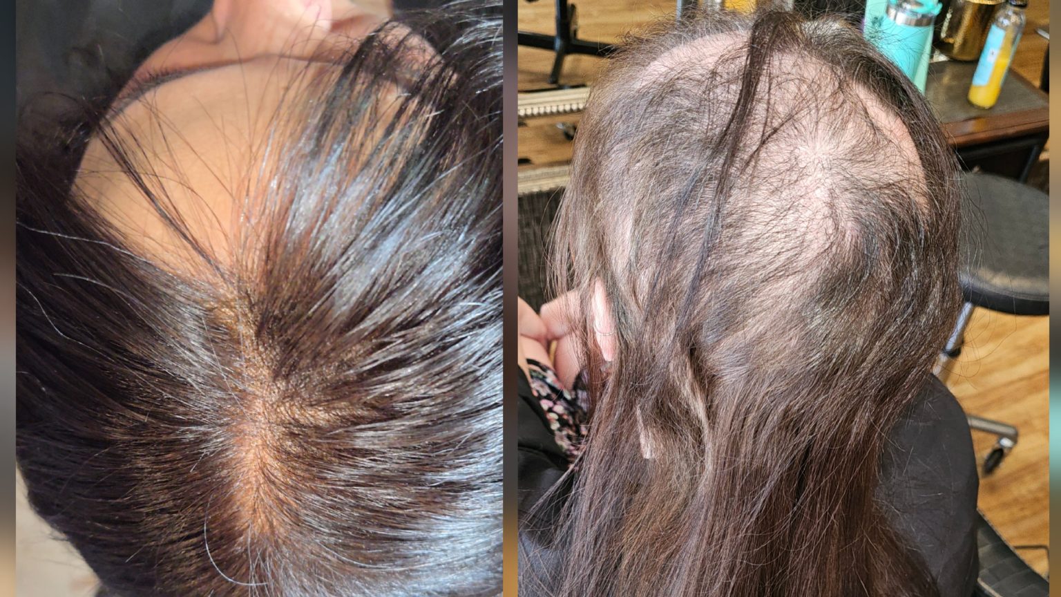Perth mesh hair replacement